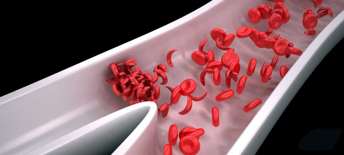La drépanocytose, c’est quoi ? - d2p-evasion